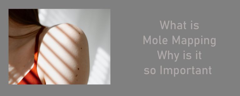 What Is Mole Mapping? Why Is It So Important? | Blogs
