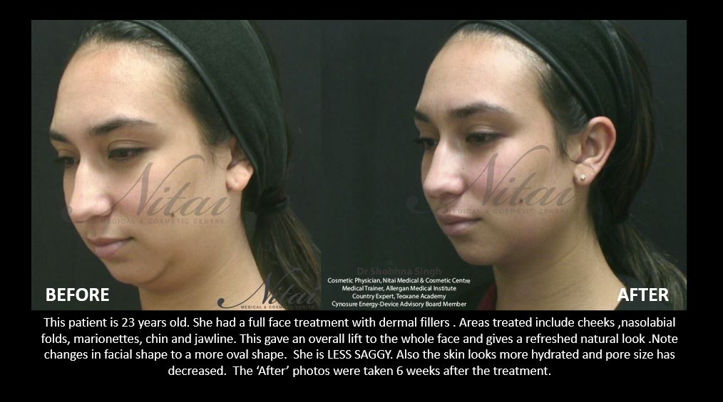 Chin Enhancement Archives - Laser Skin Treatment Clinic Melbourne