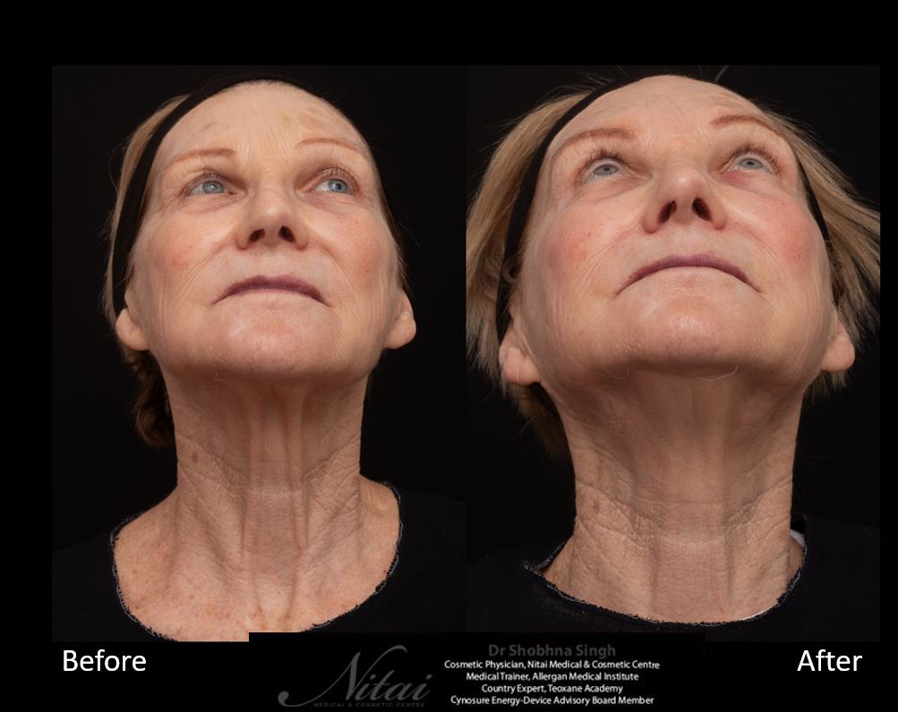 clinically approved Neck Rejuvenation treatment - Laser Skin Treatment ...