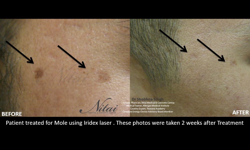 Mole Removal Before After Images - Laser Skin Treatment Clinic ...