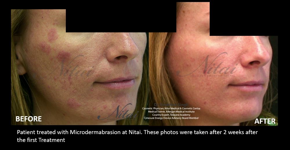 Check out our Before/After Microdermabrasion treatment photos - Laser ...